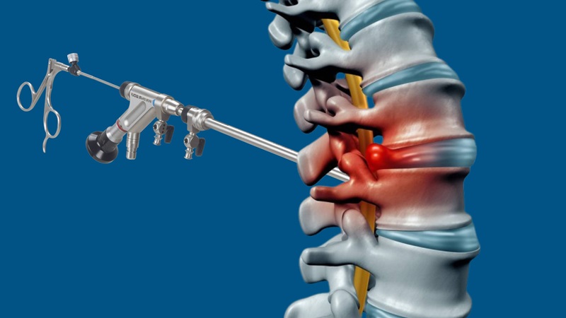Endoscopic Discectomy | Chromatic Medical Tourism